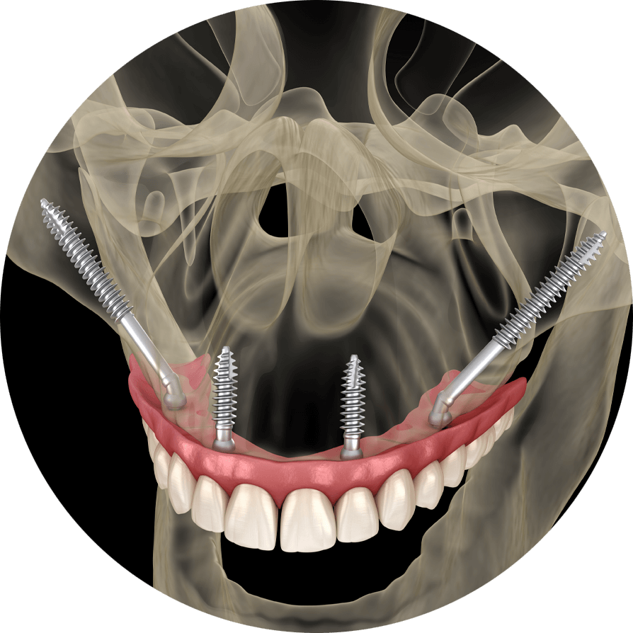 Zygomatic Dental Implants